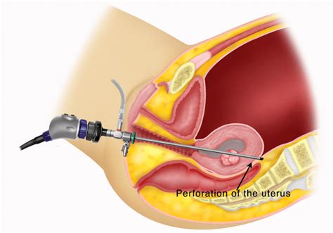 Chapter 36 Overview Of Hysteroscopy Melaka Fertility