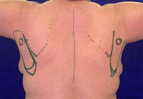 Posterior View With Planning Of Two Parascapular Flaps Download