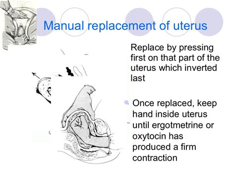 Uterine Inversion