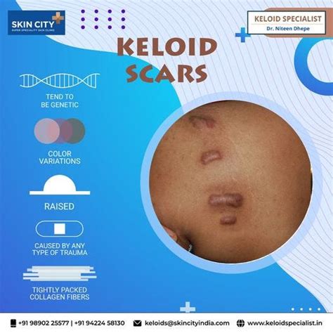Keloid Scar Treatment In Pune Keloidspecialist Medium