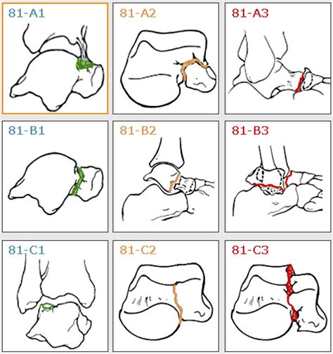 Classification Of Talus Fractures In The Sfr Download Scientific Diagram