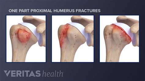 Types Of Proximal Humerus Fractures
