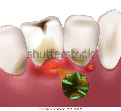 Oral Gingivitis Gum Disease Gum Inflammation Stock Vector Royalty Free