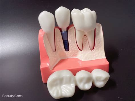 Dental Display Model Implant Model For Doctor Patient Communication Use