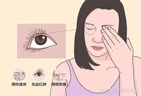 一种 眼睫毛上的”眼部疾病：鳞屑性睑缘炎 知乎