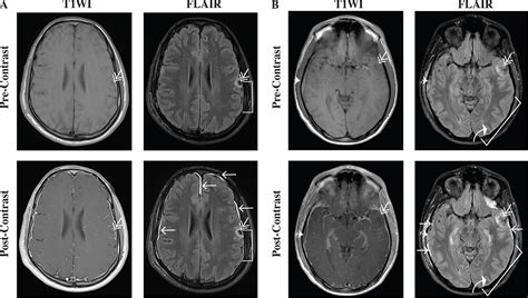 Subdural Hematoma Mri