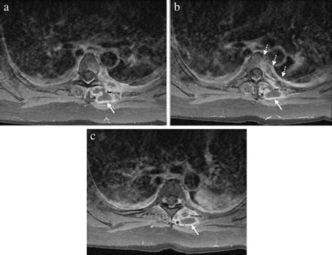 A C Axial Mri Thoracic Spine T1 Post Contrast Imaging Demonstrating