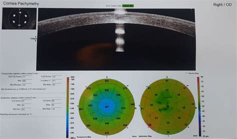 Post Lasik 3 Weeks Steroid Responder Interface Fluid Syndrome Iop
