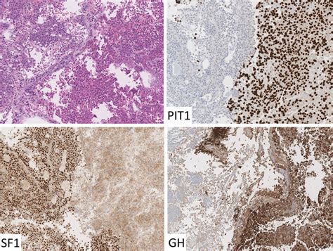 Double Pitnet The Coexistence Of Multiple Pitnets Is Not Uncommon Download Scientific Diagram
