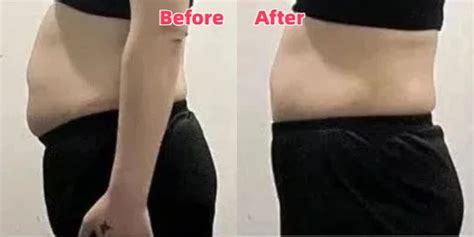 Body Fat Cavitation Before And After Liton Laser