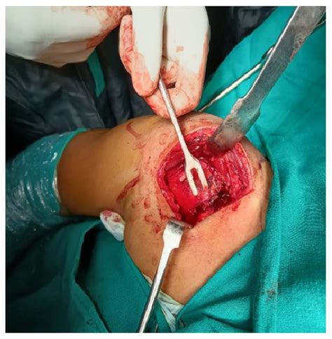 Coracoid Fracture Fragment Graft With Attached Conjoint Tendon
