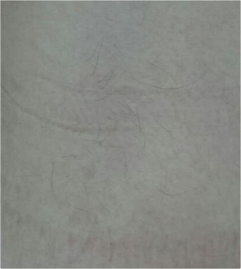 Moderate Hypertrichosis On The Patients Back Download Scientific