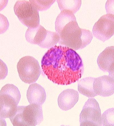 Eosinophilic Band