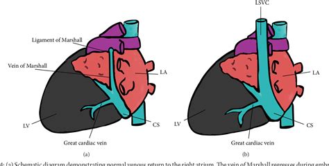 Figure 4 From The Incidental Finding Of A Persistent Left Superior Vena