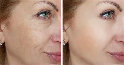 Mesotherapy Before And After Elite Beauty Concepts