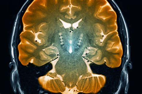 Parkinsons Disease Brain Cells That Cause The Condition Finally