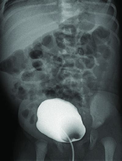 Voiding Cystourethrography Before Transurethral Endoscopic Puncture