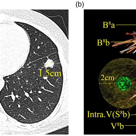 Preoperative Three‐dimensional Computed Tomography Bronchography And Download Scientific