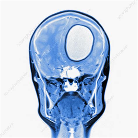 Brain Abscess Mri Sequence Stock Video Clip K0046621 Science
