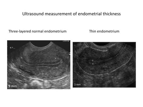 What Is The Normal Endometrial Thickness Of The Uterus At Mamie Jones Blog