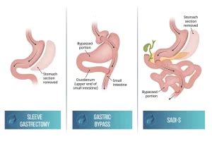 Roux En Y Gastric Bypass Single Anastomosis Gastric Bypass Weight