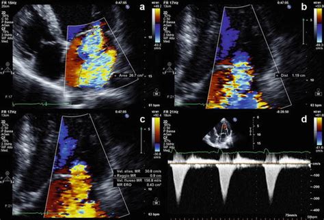 Basic Echocardiography In Dilated Cardiomyopathy Radiology Key