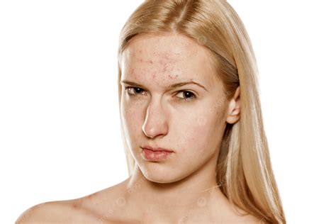 Girl With Problematic Skin Pimples Infection Acne Forehead Png