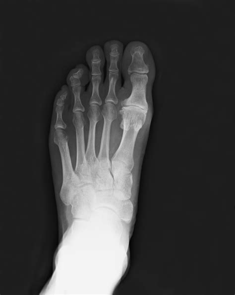 Hallux Limitusrigidus Cornwall Medical Group