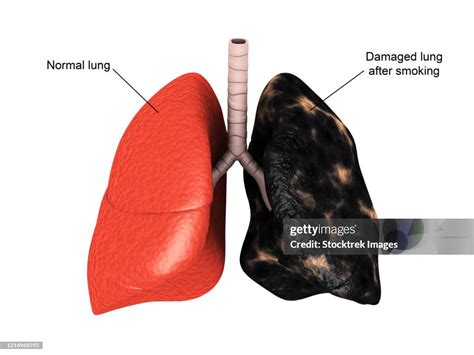 Healthy Vs Smoker Lungs Emphysema Causes Symptoms Diagnosis