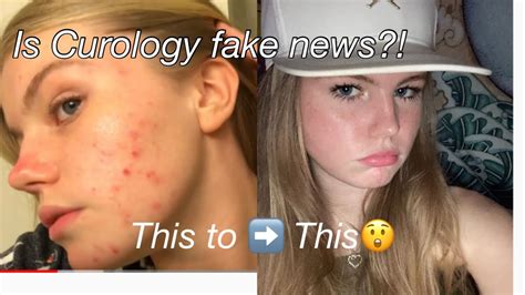 Does Curology Really Get Rid Of Acne Or Is It Just Fake News The