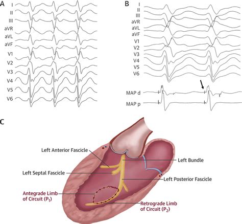 Catheter Ablation Of Ventricular Tachycardia In Structurally Normal