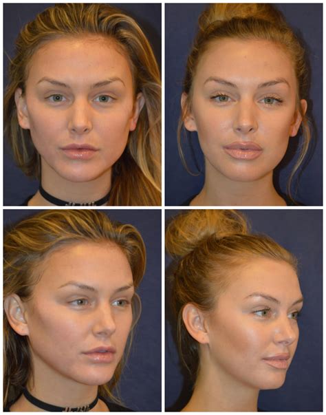 Vanderpump Rules Lala Kent Tells All On Recent Cosmetic Procedures