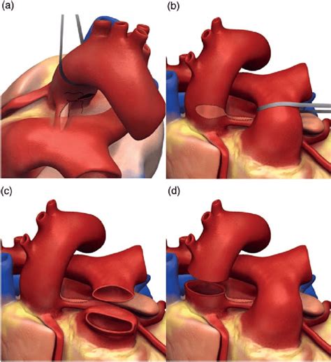 Approaches To Surgical Patch Angioplasty Of The Left Main Stem A