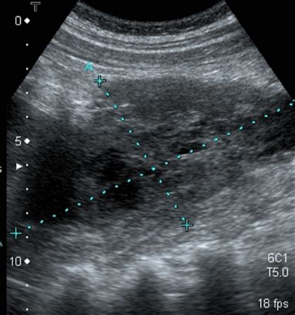 Groin Thrombophlebitis Superficial