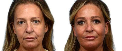 Patient 152132 Deep Plane Facelift Before And After Photos Dr Wise