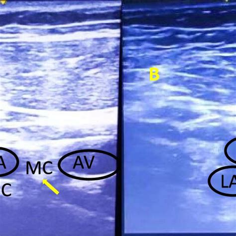 A Ultrasound Image Showing The Infraclavicular Fossa Axillary Artery
