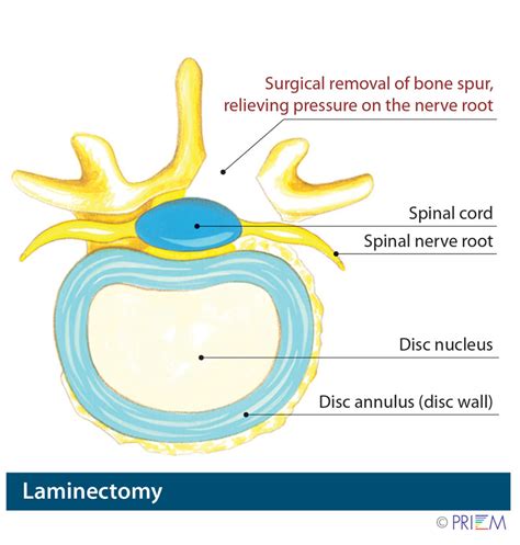 Spine Surgery And Spine Surgeon San Jose Santa Clara San Mateo