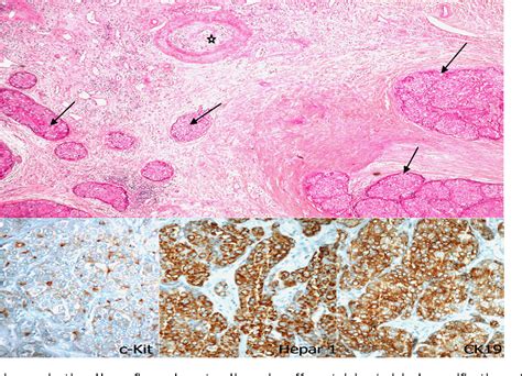 Figure 2 From Radiation Induced Cholangitis With Hepatocellular Carcinoma Semantic Scholar Figure 2 From Radiation Induced Cholangitis With Hepatocellular Carcinoma Semantic Scholar