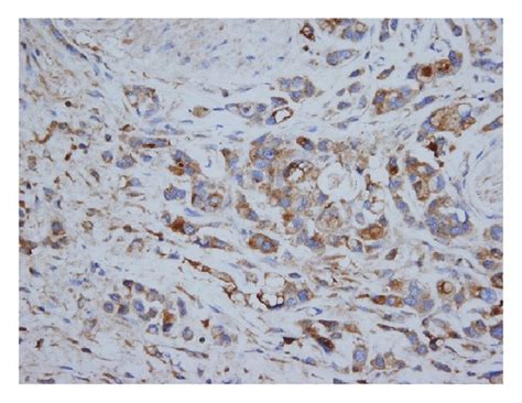 Case 1 A And Case 4 B Showed Strong Diffuse Immunopositivity For Cd138 Download