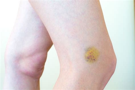 Essential Oils For The Skin And Scab Healing Leaftv