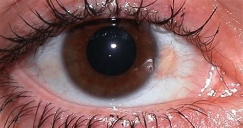 White Spot On Conjunctiva