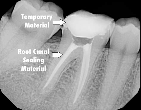 What Is A Root Canal Build Up And Crown Advance Dental Birmingham