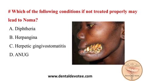 Dentosphere World Of Dentistry Condition Which May Lead To Noma
