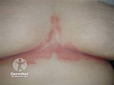 Flexural Psoriasis Images