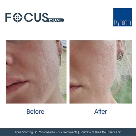 Does Rf Microneedling Help With Acne Scars · Laser Clinic