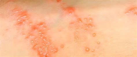 Fitofotodermatite O Que é E Como Prevenir Dra Ariane Geller