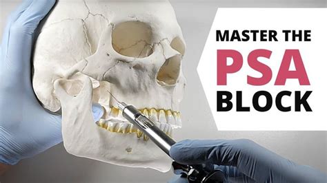 Psa Nerve Block Dental Apex Anatomy Oral Surgery Posterior Superior