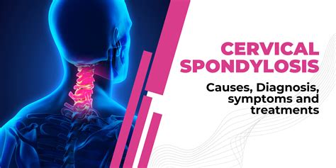 Cervical Spondylosis Causes Diagnosis Symptoms And Treatments