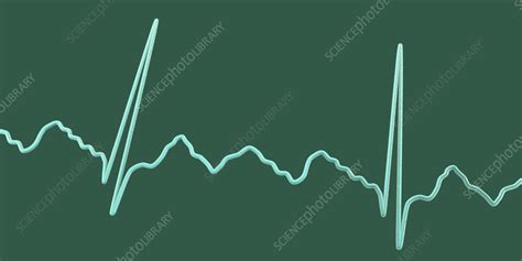 Atrial Flutter Abnormal Heartbeat Rhythm Illustration Stock Image
