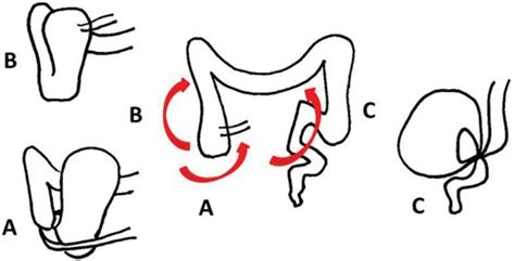 Volvulus Anaesthetic Management Of Acute Gastric Volvulus In An Adult